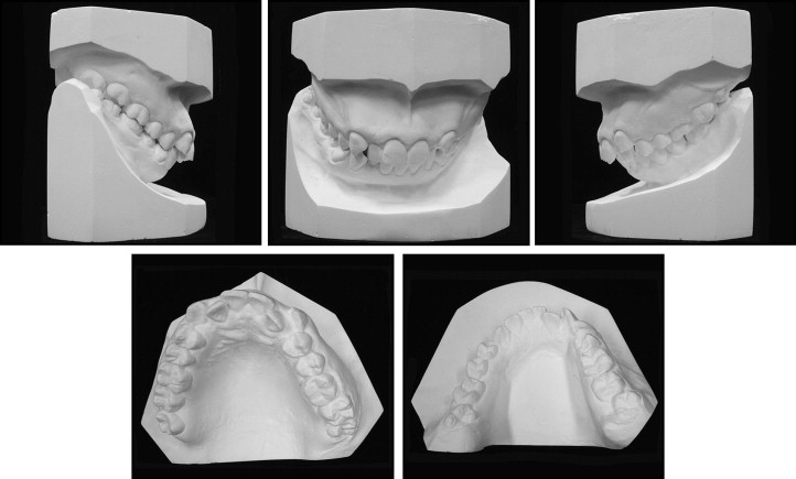 Bilateral Craniofacial Microsomia Orthognathic Treatment For An