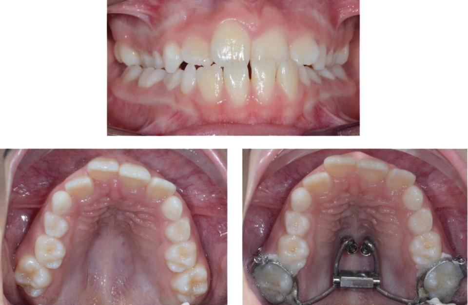 Treatment For Class Iii Malocclusion Pocket Dentistry