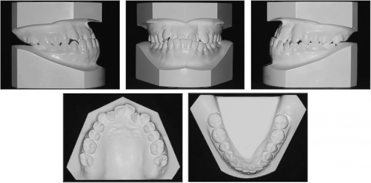 Nonsurgical Treatment Of An Adult With A Skeletal Class Iii