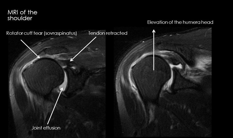 Rotator Cuff Tear Sovraspinatus Tendon Retracted Joint Effusion