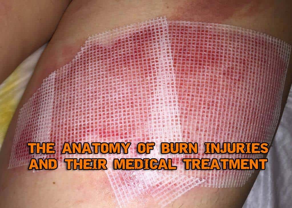 The Anatomy Of Burn Injuries And Their Medical Treatment