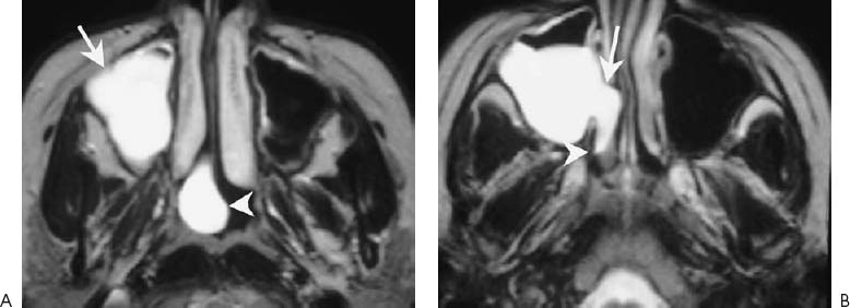 Antrochoanal Polyp Radiology Key