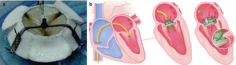 Percutaneous Management Of Mitral Regurgitation Radiology Key