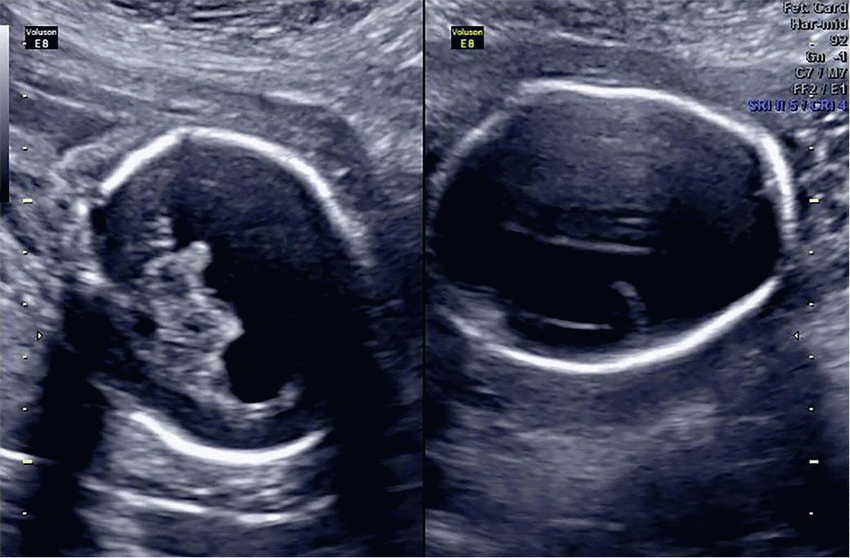 Second And Third Trimester Pregnancy Radiology Key