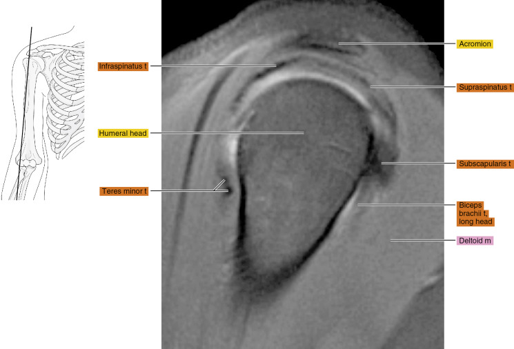 Mr Arthrography Of The Shoulder Radiology Key