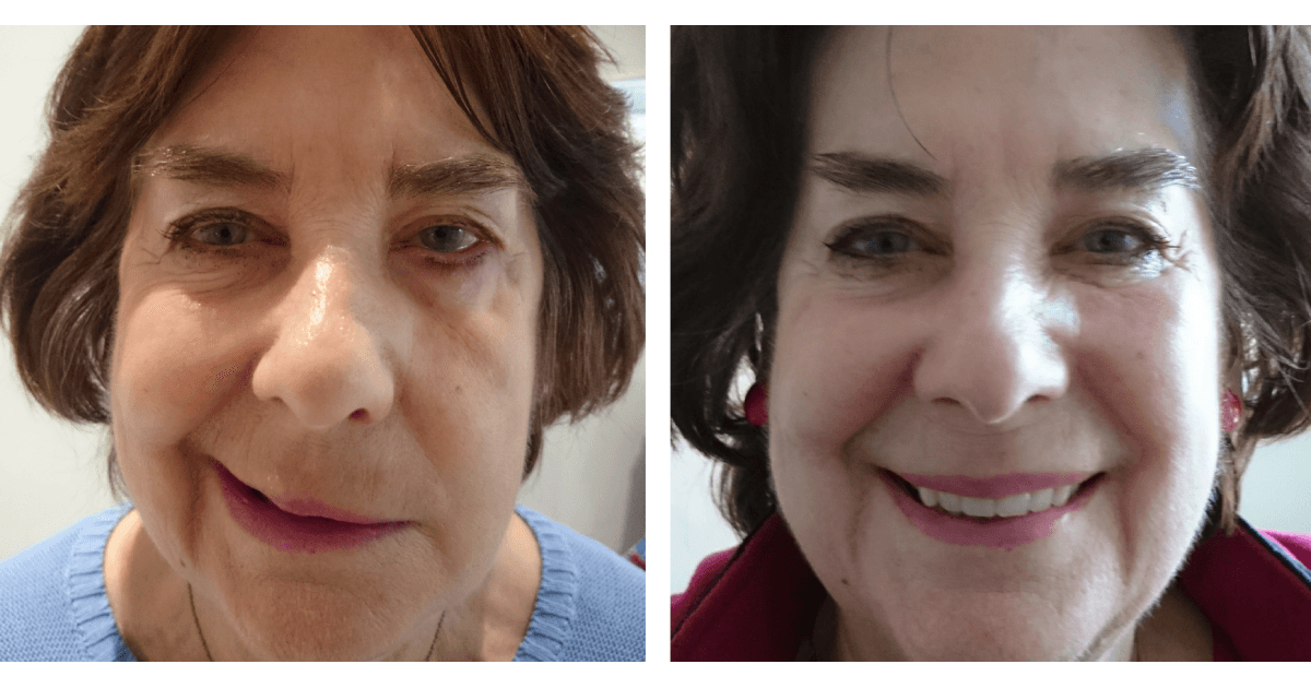 Bells Palsy Vs Stroke The Difference Between Bell S Palsy And Stroke