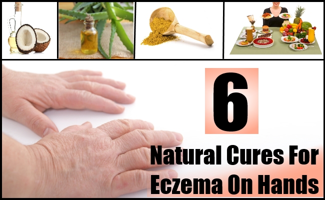 6 Natural Cures For Eczema On Hands Natural Home Remedies And Supplements