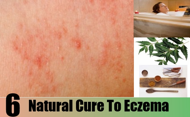 Top 6 Natural Cures For Eczema In Adults Natural Home Remedies