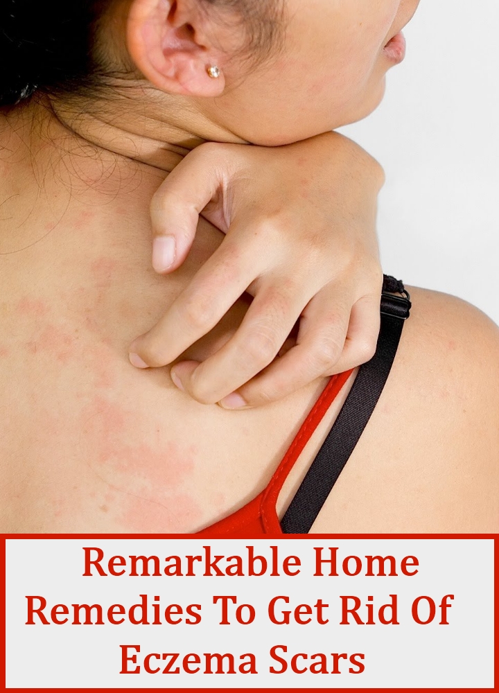 7 Remarkable Home Remedies To Get Rid Of Eczema Scars Natural Home