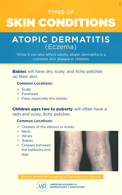 Atopic Dermatitis Dawes Fretzin Dermatology Group