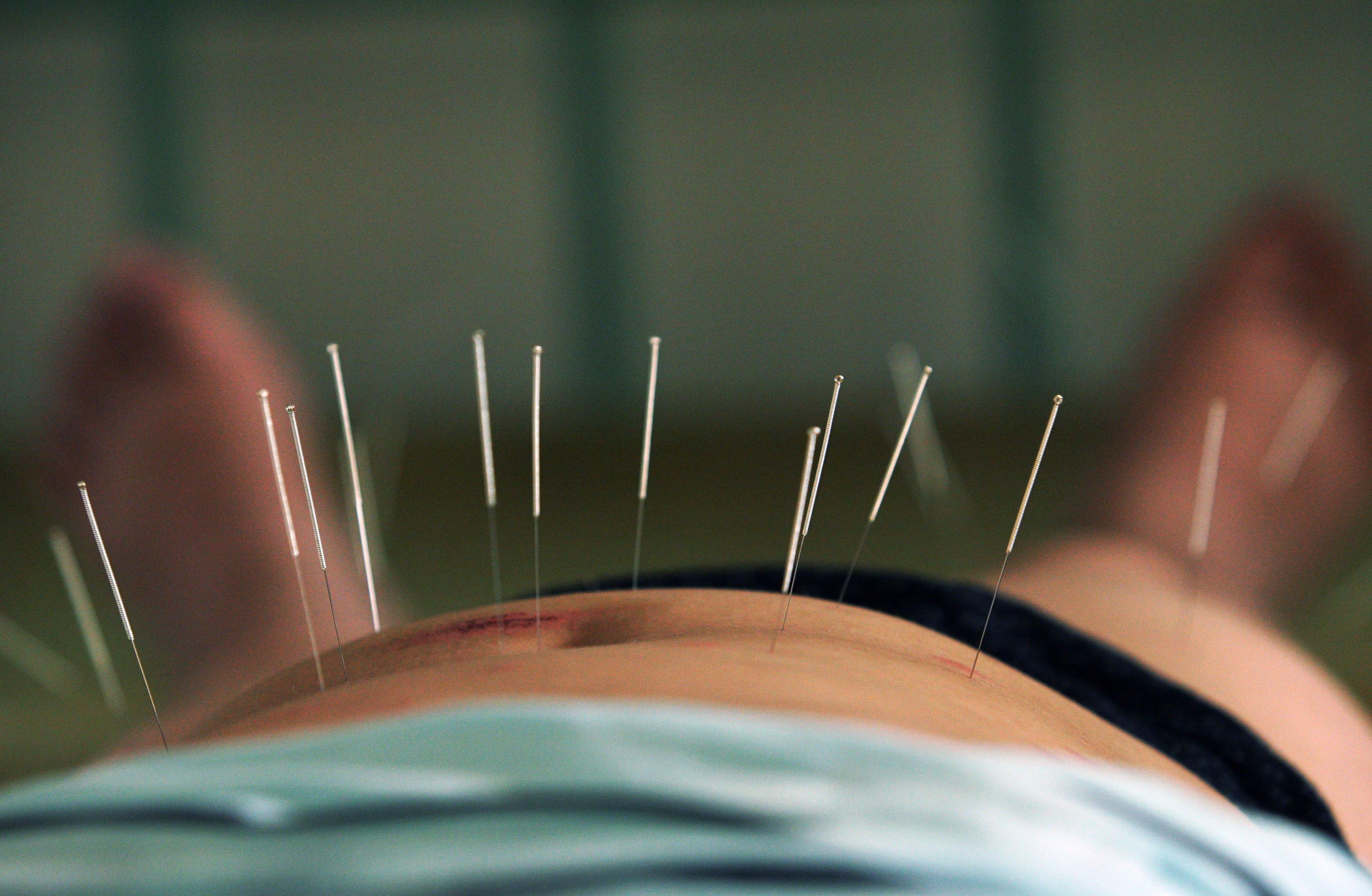 Acupuncture For Weight Loss Beauty And Laser Clinic