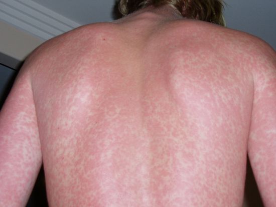 Difference Between Hives And Rash Compare The Difference Between