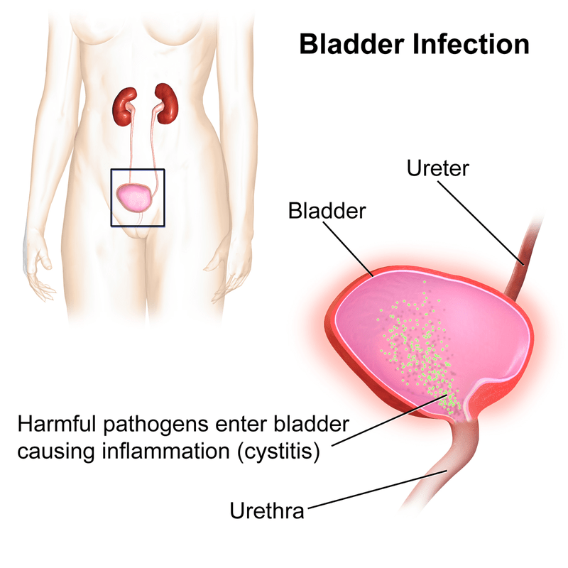 Difference Between Uti And Bladder Infection Compare The Difference