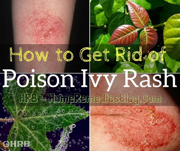 How To Get Rid Of Poison Ivy Rash 14 Fast Home Remedies