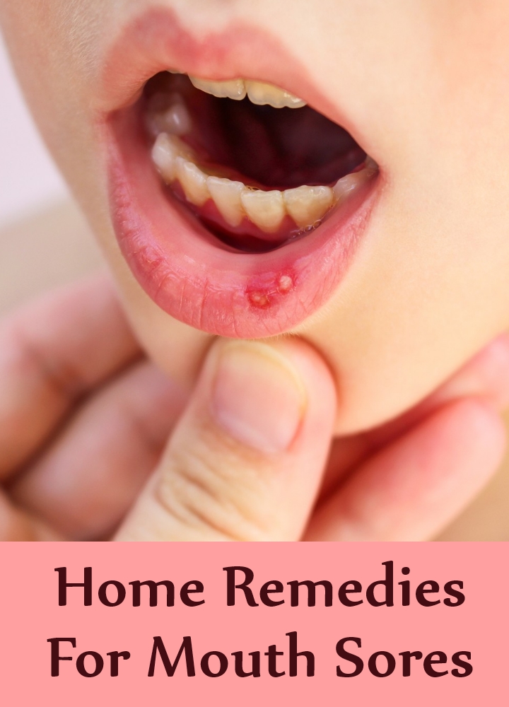 6 Home Remedies For Mouth Sores Search Home Remedy