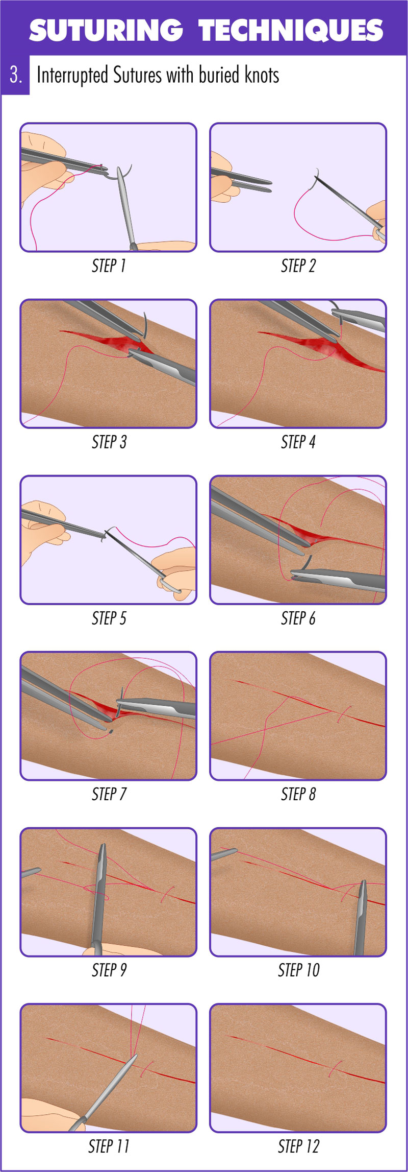 Complete Guide To Mastering Suturing Techniques