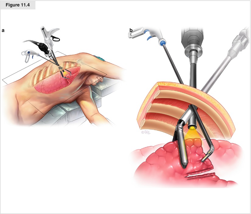 Vats Wedge Resection Thoracic Key