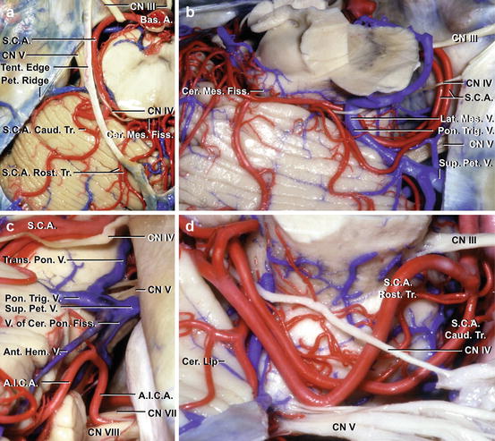 Microsurgical Anatomy For Microvascular Decompression Surgery