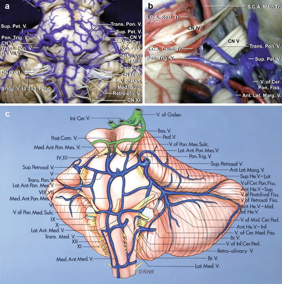 Microsurgical Anatomy For Microvascular Decompression Surgery