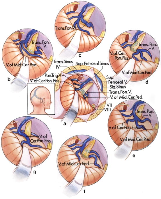 Microsurgical Anatomy For Microvascular Decompression Surgery