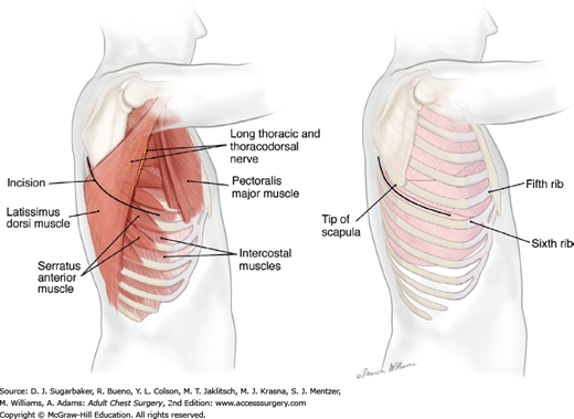 Thoracic Incisions Thoracic Key