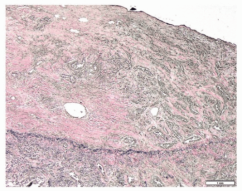 Staging Of Lung Cancer Thoracic Key