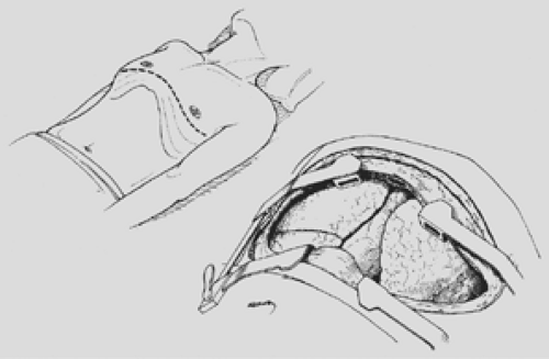 Thoracic Incisions Thoracic Key