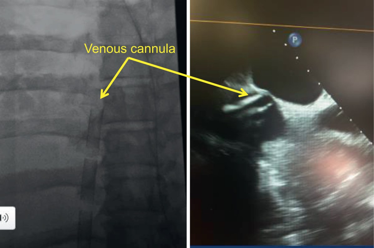 Hemodynamic Support Thoracic Key