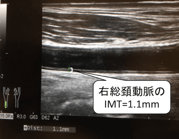 頸動脈エコーでわかることは？正常値は？徹底解説！