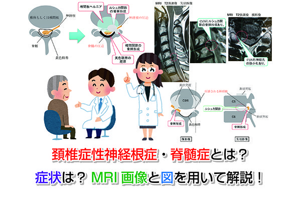 頚椎症性神経根症・脊髄症とは？症状は？mri画像と図を用いて解説！