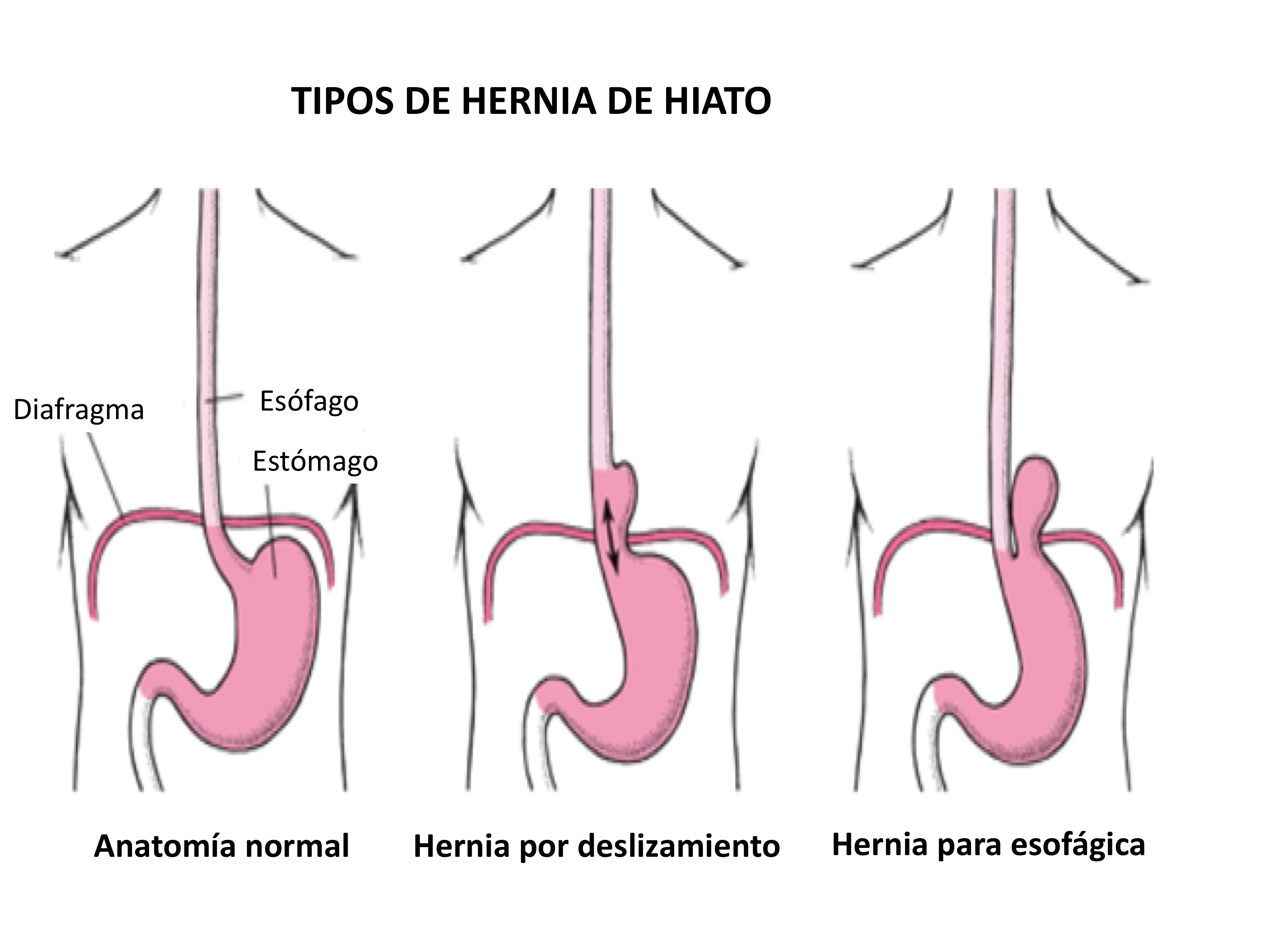 ¿qué Es Una Hernia De Hiato Dr Onofre Alarcón Médico Especialista