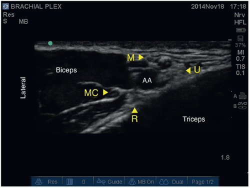 Brachial Plexus Block Anesthesia Key