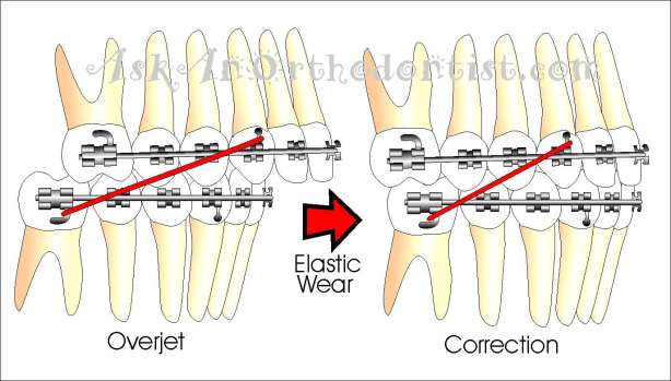 What Do The Elastic Rubber Bands On Braces Do Ask An