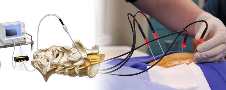 Radiofrequency Neurotomy Indications And Procedure Bone And Spine