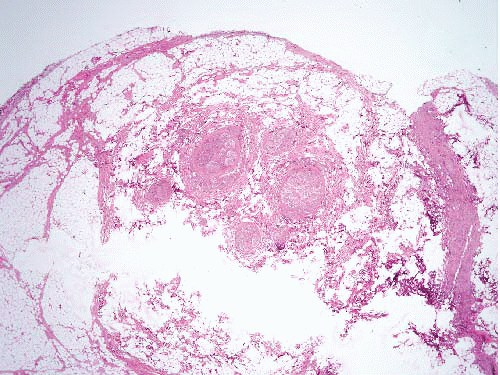 Benign Adipose Tissue Lesions Basicmedical Key