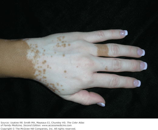 Vitiligo And Hypopigmentation Basicmedical Key