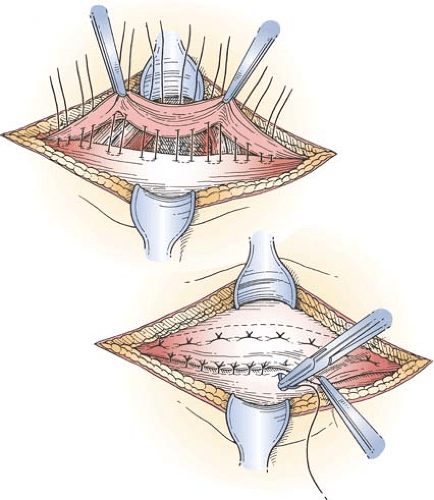 Laparoscopic Inguinal Hernia Repair Basicmedical Key