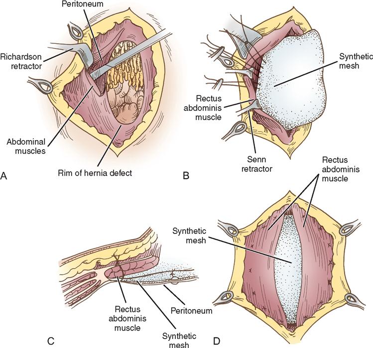 4 Repair Of Hernias Basicmedical Key