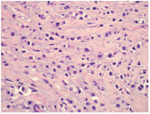 Invasive Carcinoma Special Types And Important Considerations