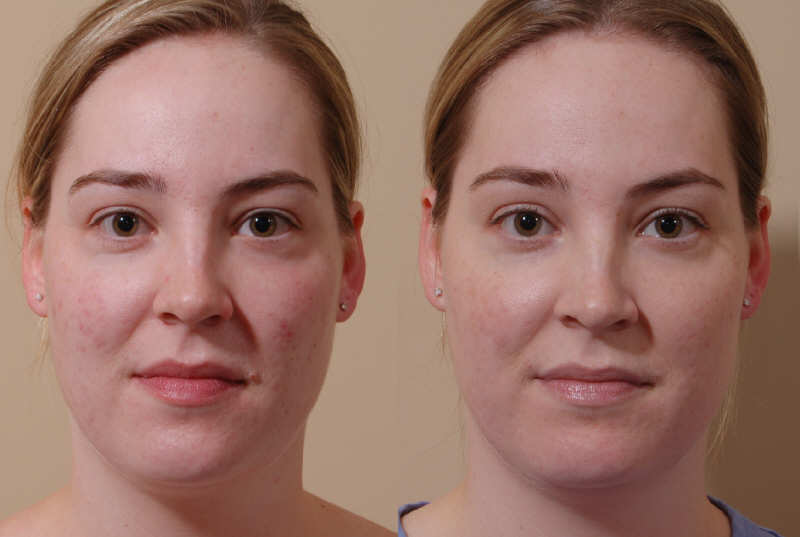 Erbium Laser Under Eyes Before And After