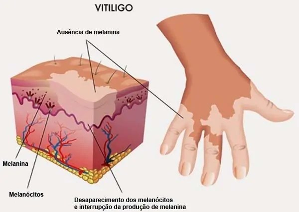 Vitiligo Tem Cura Saiba O Que é Suas Causas Sintomas E Tratamento