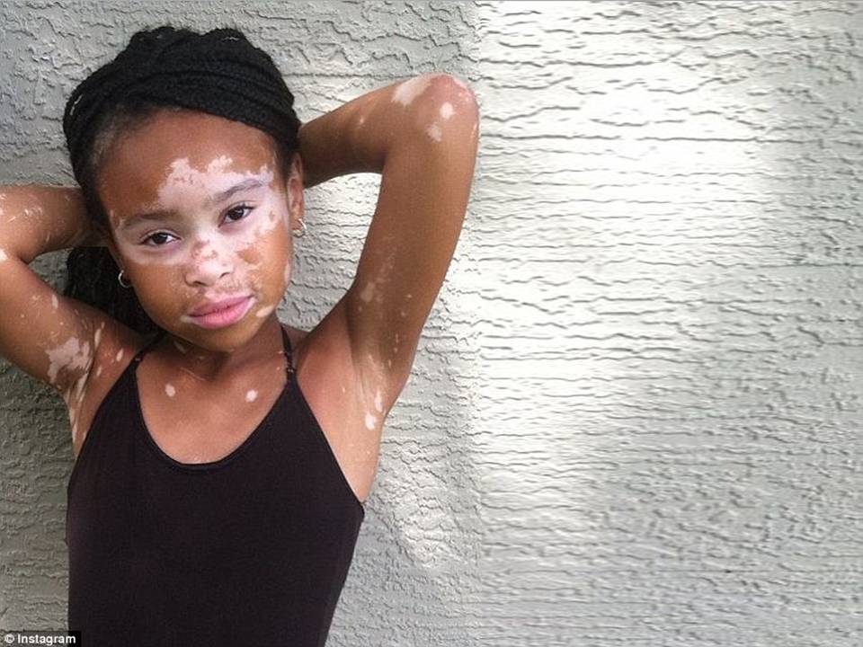 April Star With Vitiligo Wants To Be A Model Blackdoctor