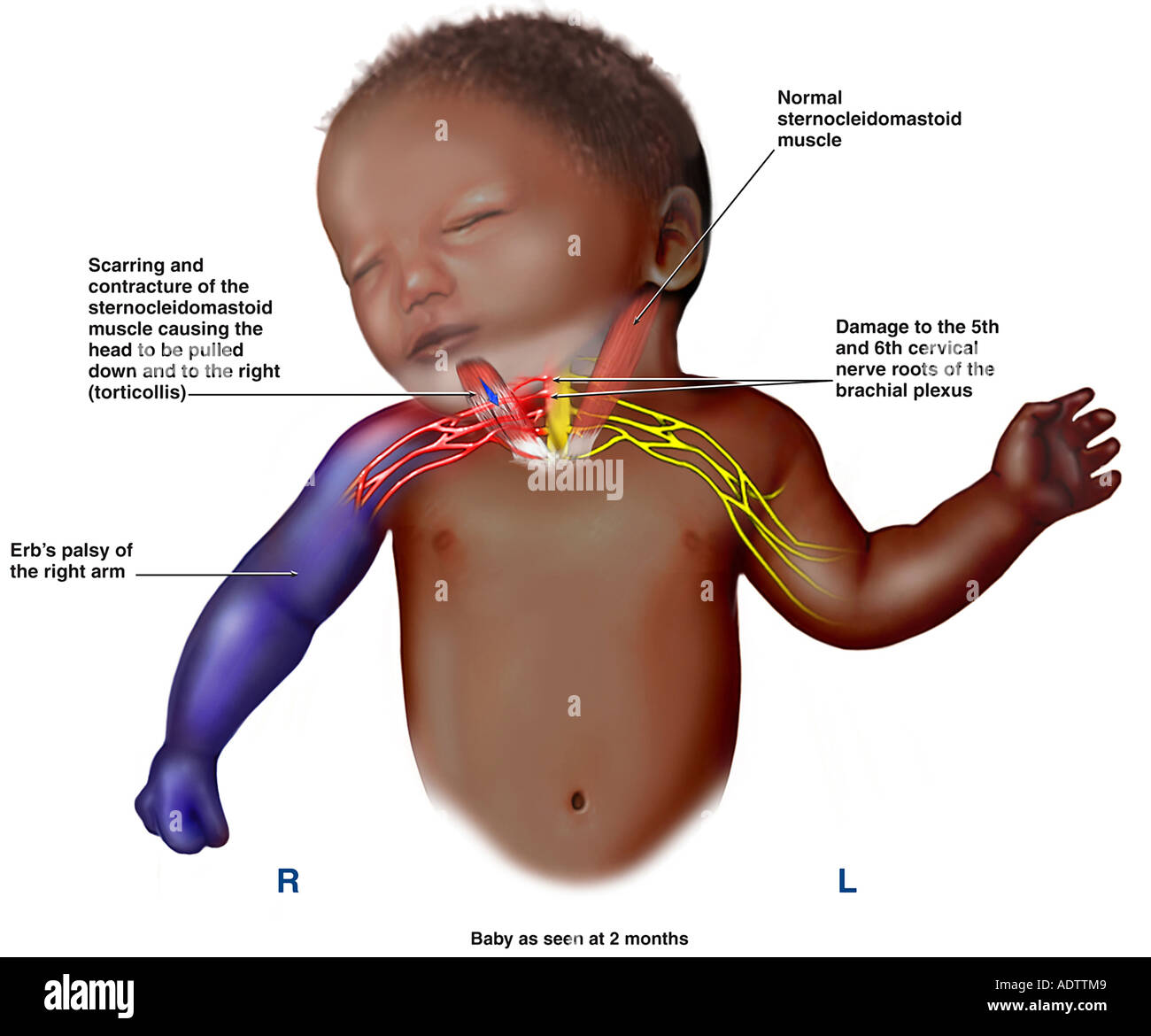 Newborn Brachial Plexus Injuries Causes Symptoms And Treatment
