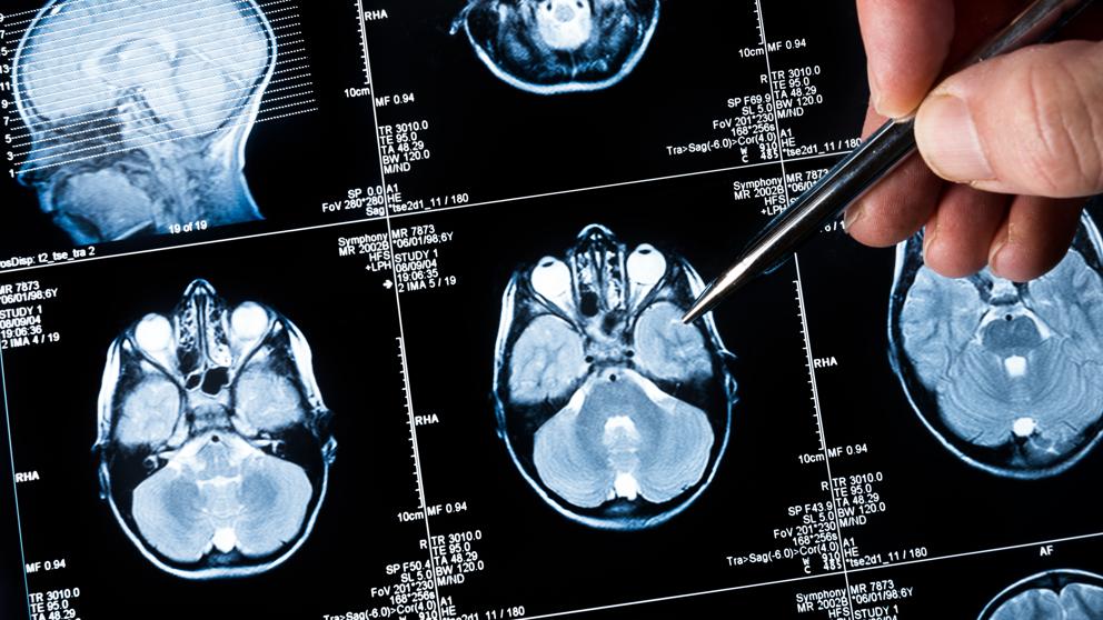 ¿tumor Cerebral ¡infórmese Gamma Knife