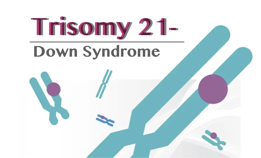 Trisomy 21 Down Syndrome Definition Causes Symptoms Pictures And