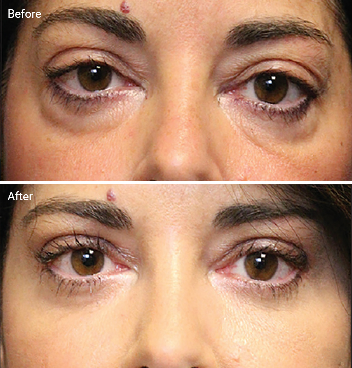 Get Fraxel Laser For Under Eye Bags Pics