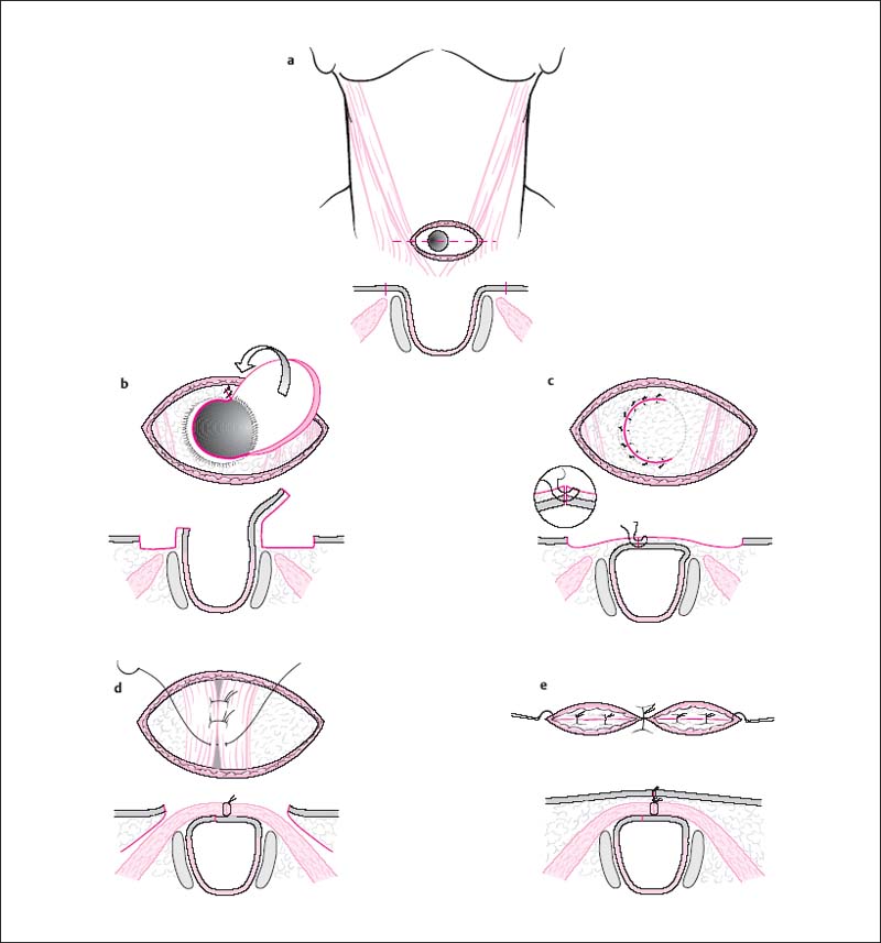 Reconstructive Plastic Surgery Of The Face Ento Key