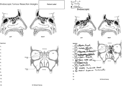 Standard Endoscopic Approaches In Frontal Sinus Surgery Ento Key