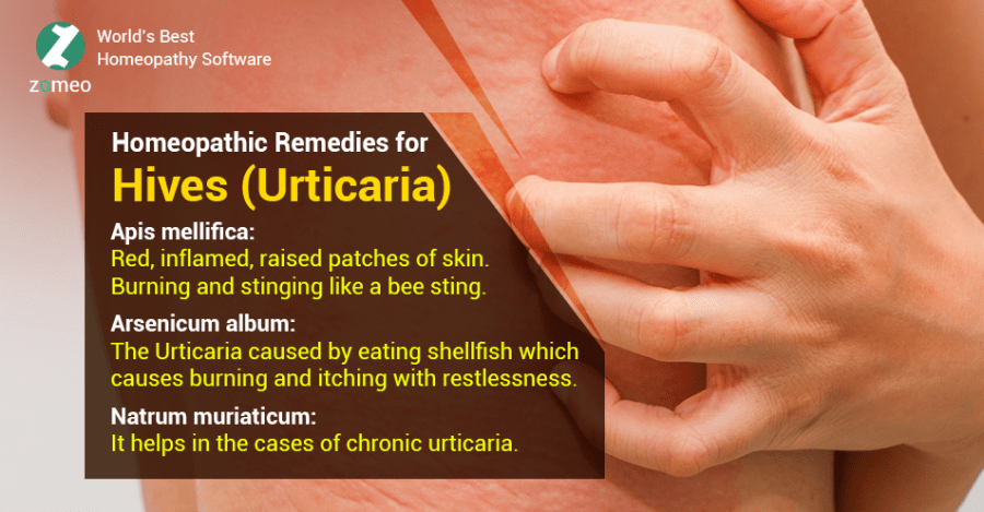 Homeopathic Remedies For Hives Urticaria Hompath