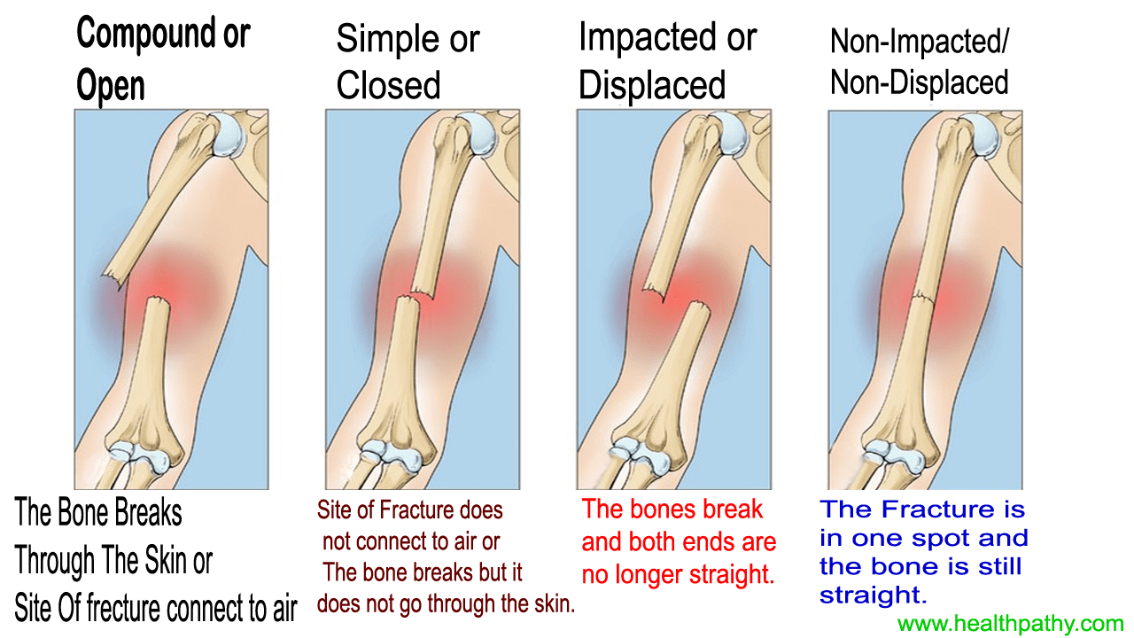 Classification Of Fracture Definition Sign And Symptom Medical Notes